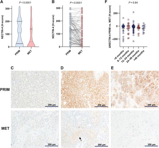 Membranous NECTIN-4 Expression Frequently Decreases during Metastatic ...