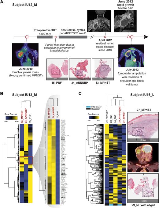 Spatial Gene-Expression Profiling Unveils Immuno-oncogenic Programs of ...