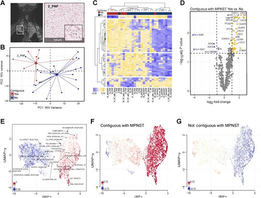 Spatial Gene-Expression Profiling Unveils Immuno-oncogenic Programs of NF1-Associated Peripheral ...
