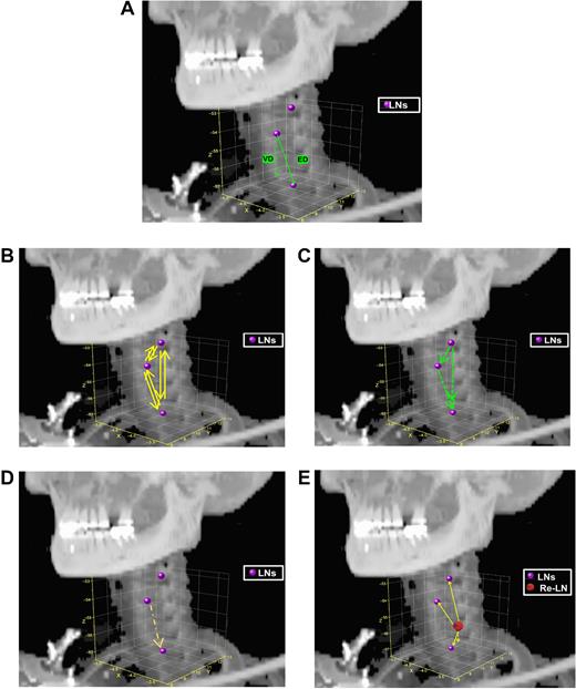 Optimizing Cervical Target Volume in Patients with Nasopharyngeal ...