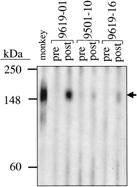Human Autoantibodies to Carcinoembryonic Antigen (CEA) Induced by a ...