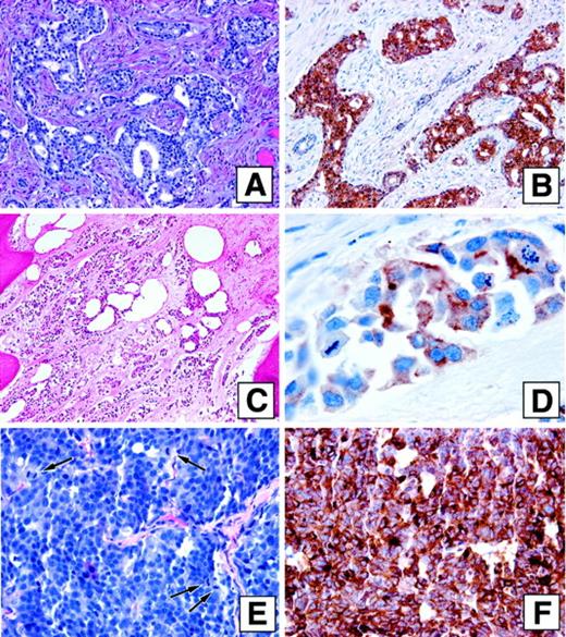 Rapid (“Warm”) Autopsy Study for Procurement of Metastatic Prostate ...