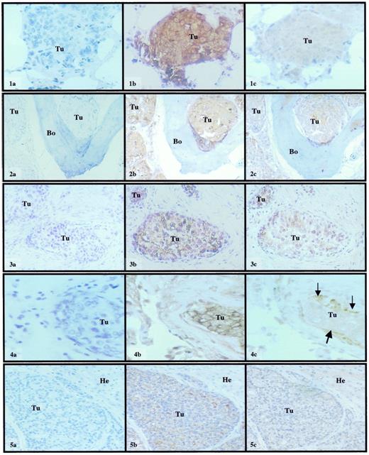 Differential Expression of Osteonectin/SPARC during Human Prostate ...