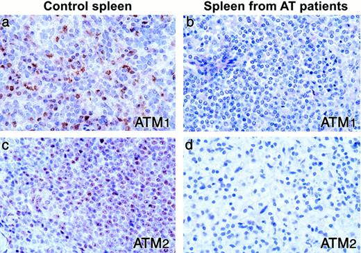 Abnormal Expression of the ATM and TP53 Genes in Sporadic Breast ...