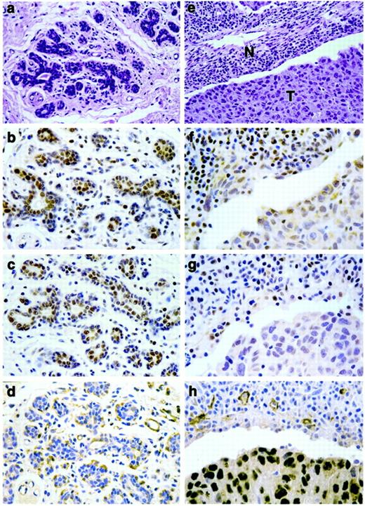 Abnormal Expression of the ATM and TP53 Genes in Sporadic Breast ...
