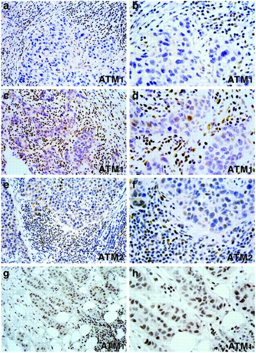 Abnormal Expression of the ATM and TP53 Genes in Sporadic Breast ...