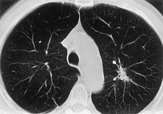 Early Detection of Lung Cancer: Clinical Perspectives of Recent ...