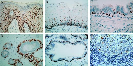 p63 Expression Profiles in Human Normal and Tumor Tissues1 | Clinical ...