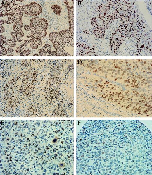 p63 Expression Profiles in Human Normal and Tumor Tissues1 | Clinical ...