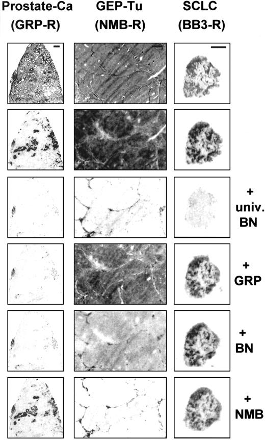Bombesin Receptor Subtypes in Human Cancers | Clinical Cancer Research ...