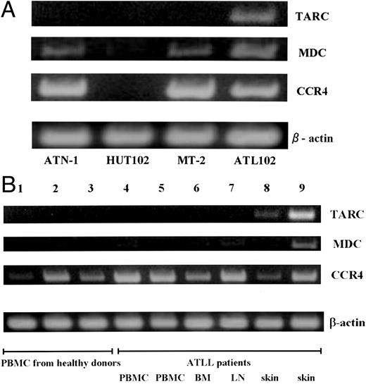 Clinical Significance of CCR4 Expression in Adult T-Cell Leukemia ...