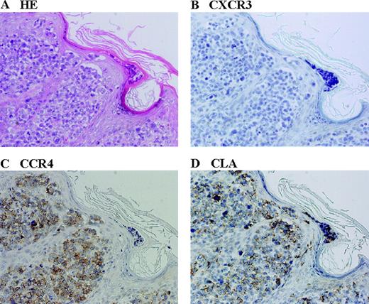 Clinical Significance of CCR4 Expression in Adult T-Cell Leukemia ...