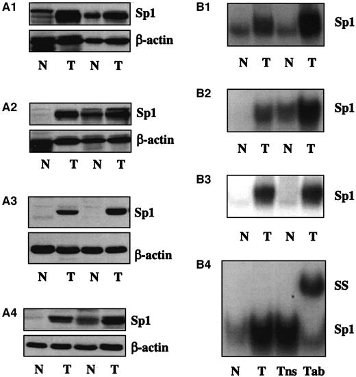 Transcription Factor Sp1 Expression Is a Significant Predictor of ...