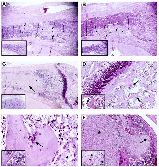 Prostate Cancer Cells-Osteoblast Interaction Shifts Expression of ...