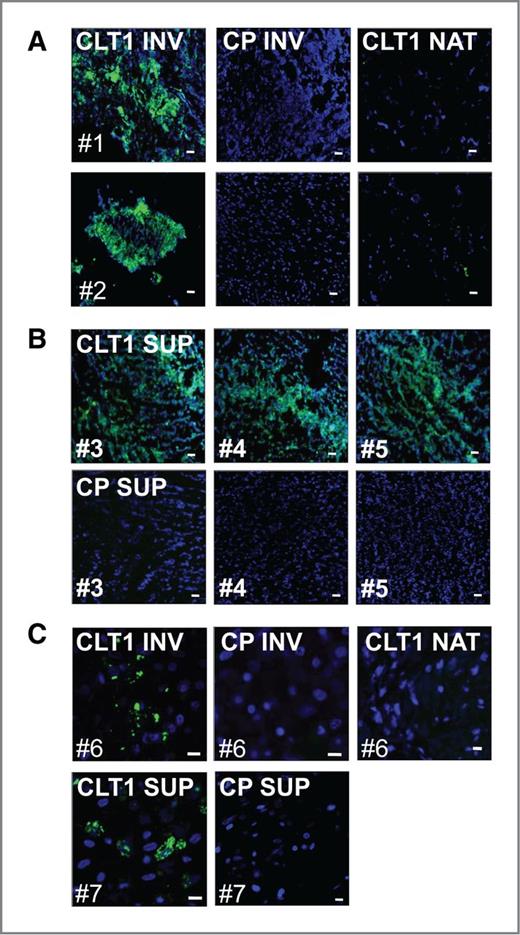 CLT1 Targets Bladder Cancer through Integrin α5β1 and CLIC3 | Molecular ...