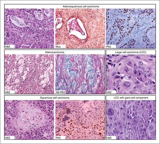 Human Lung Epithelial Cells Progressed to Malignancy through Specific ...