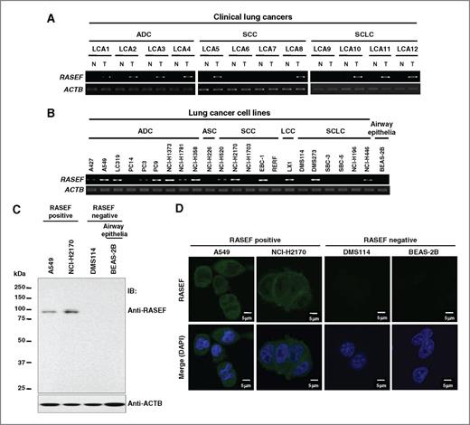 RASEF is a Novel Diagnostic Biomarker and a Therapeutic Target for Lung ...