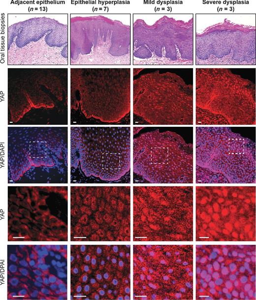 A YAP/TAZ-Regulated Molecular Signature Is Associated with Oral ...