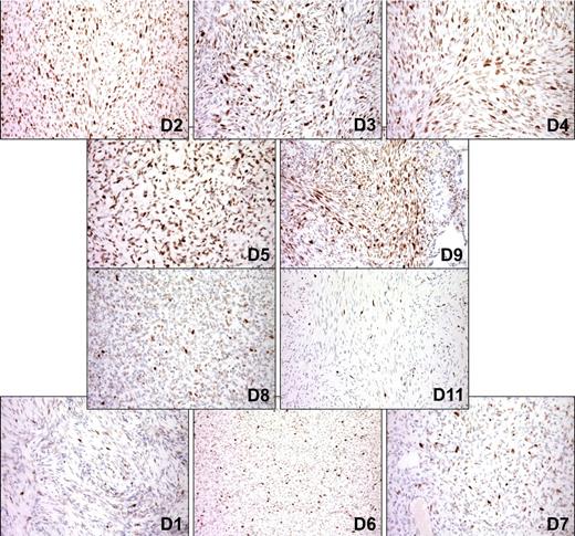 Evolution of Dermatofibrosarcoma Protuberans to DFSP-Derived ...