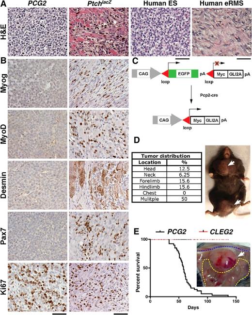 Insight into the Etiology of Undifferentiated Soft Tissue Sarcomas from ...