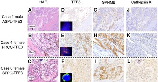 TFE3 Xp11.2 Translocation Renal Cell Carcinoma Mouse Model Reveals ...