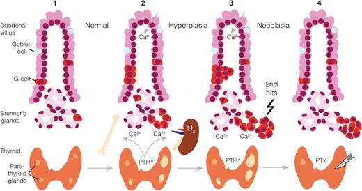A Parathyroid–Gut Axis: Hypercalcemia and the Pathogenesis of ...