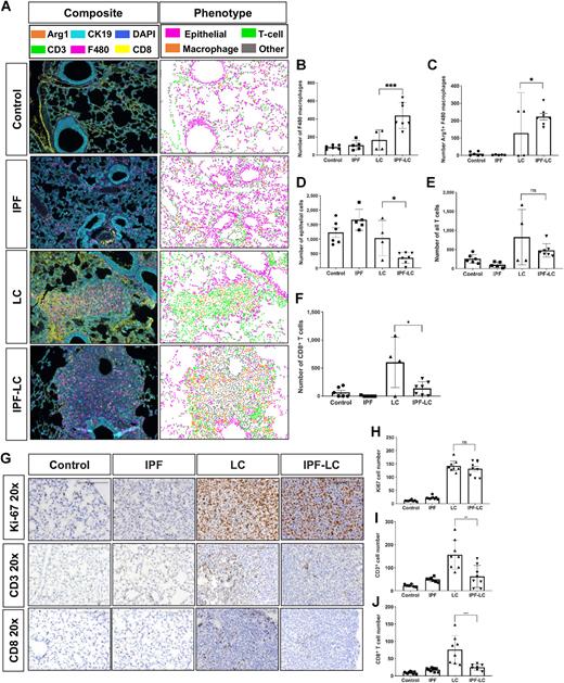 Modeling Molecular Pathogenesis of Idiopathic Pulmonary Fibrosis ...