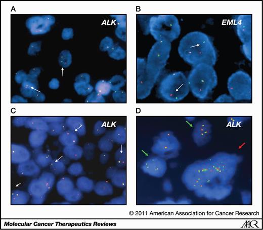 Targeting Oncogenic ALK: A Promising Strategy for Cancer Treatment ...