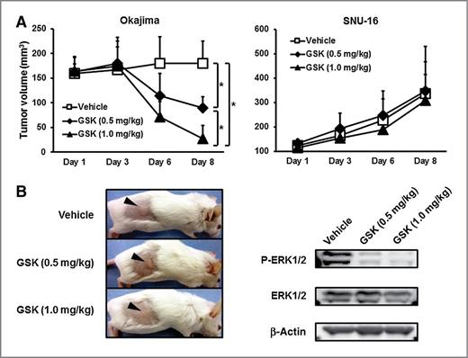 MEK Inhibitor for Gastric Cancer with MEK1 Gene Mutations | Molecular ...