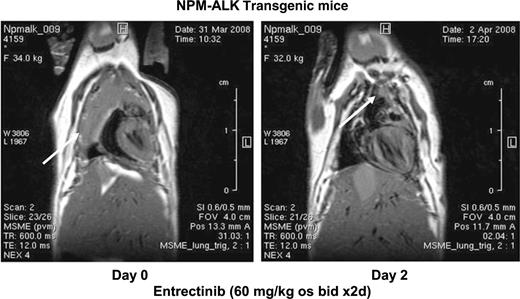 Entrectinib, a Pan–TRK, ROS1, and ALK Inhibitor with Activity in ...