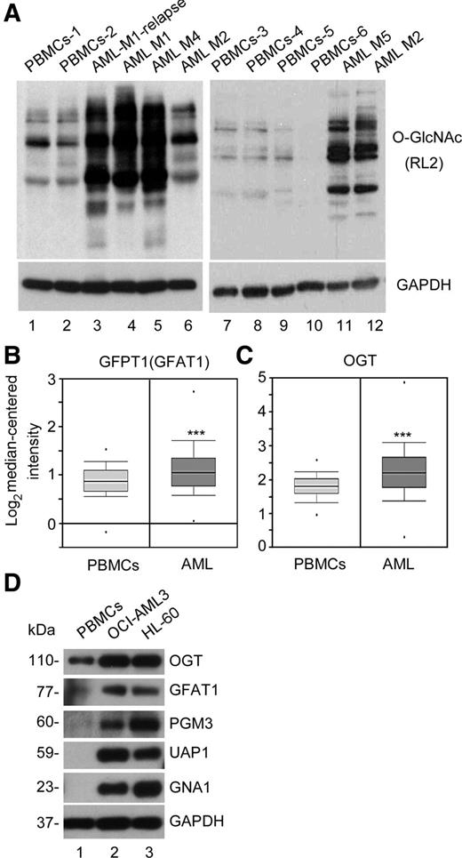 Hexosamine Biosynthetic Pathway Inhibition Leads to AML Cell ...