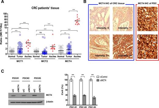 MCT4 Expression Is a Potential Therapeutic Target in Colorectal Cancer ...