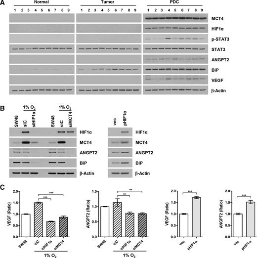 MCT4 Expression Is a Potential Therapeutic Target in Colorectal Cancer ...