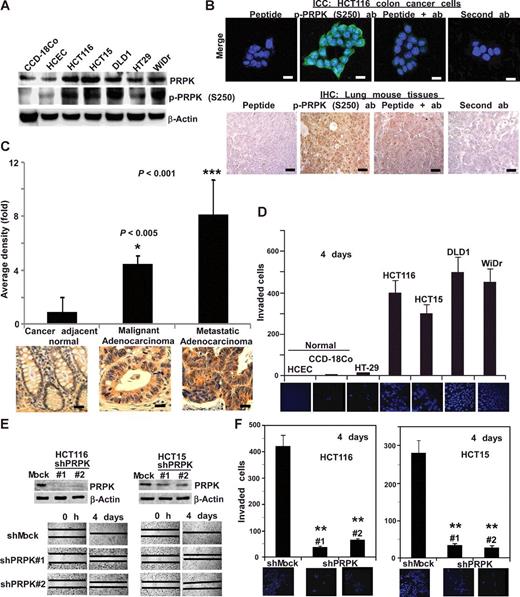Targeting PRPK Function Blocks Colon Cancer Metastasis | Molecular ...