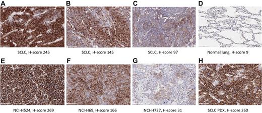 RYZ101 (Ac-225 DOTATATE) Opportunity beyond Gastroenteropancreatic ...