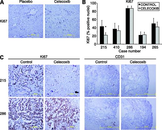 Assessment of celecoxib pharmacodynamics in pancreatic cancer ...