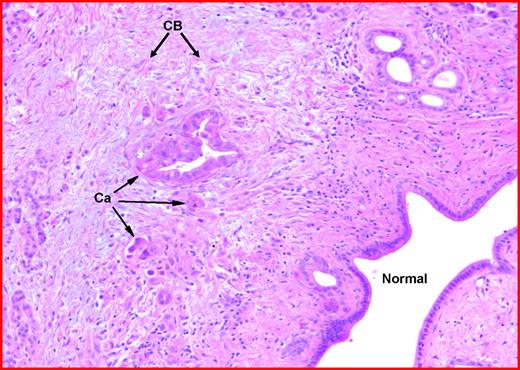 Tumor-stroma interactions in pancreatic ductal adenocarcinoma ...