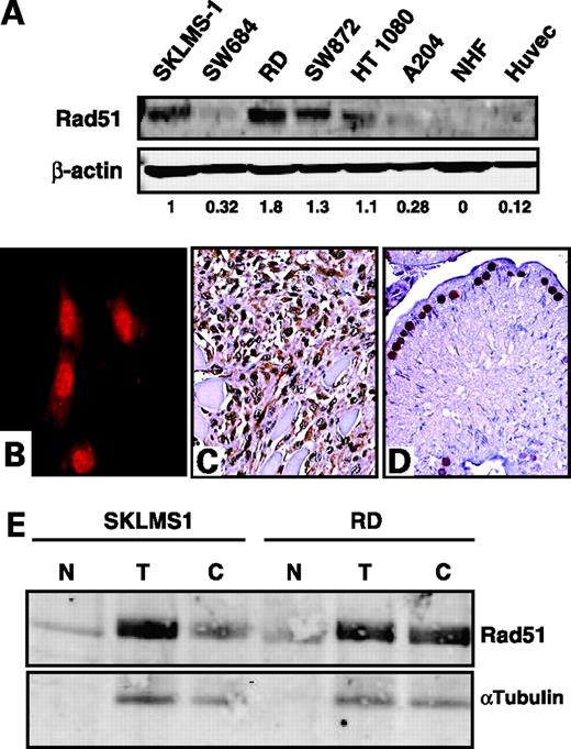Rad51 overexpression contributes to chemoresistance in human soft ...