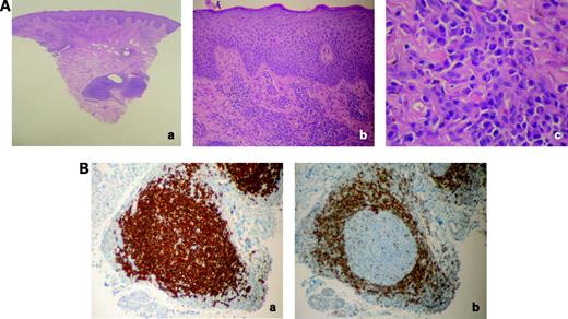Cutaneous castleman's disease responds to anti–interleukin-6 treatment ...