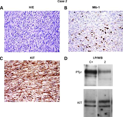 Activate and resist: L576P-KIT in GIST | Molecular Cancer Therapeutics ...